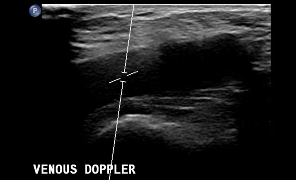 Vascular (Doppler) Scan - Ultrasound Scan